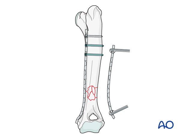Double plating for Dog humeral diaphyseal fracture with non-reducible wedge