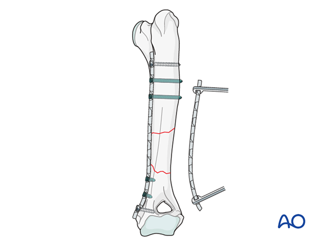 Double plating for Complex segmental dog humeral diaphyseal fracture