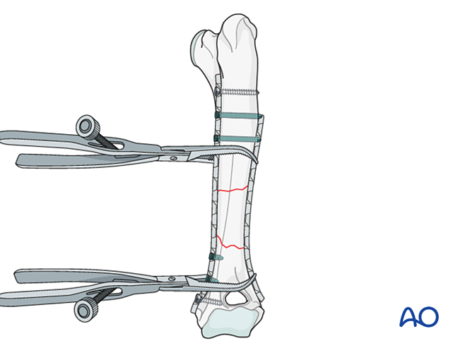 Double plating for Complex segmental dog humeral diaphyseal fracture