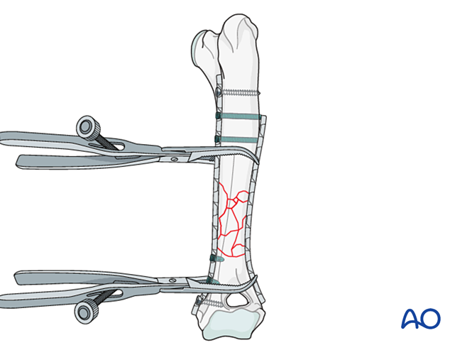 Double plating for Dog humeral diaphyseal fracture with complex non ...