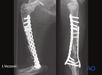 Double plating for Dog humeral diaphyseal fracture with complex non ...