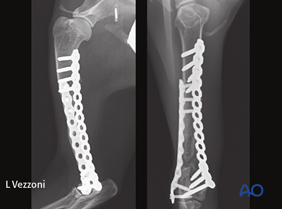 Double plating for Dog humeral diaphyseal fracture with complex non ...