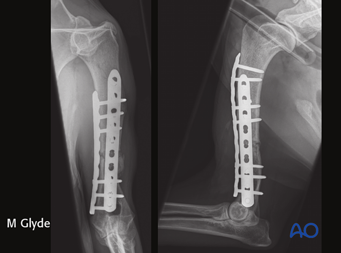 Double plating for Dog humeral diaphyseal fracture with complex non ...