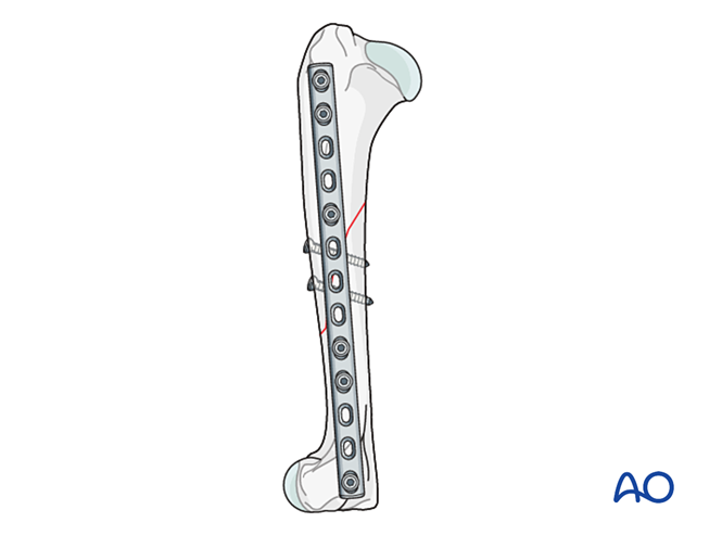 Lag screws and neutralization plate for Simple oblique fracture of the ...