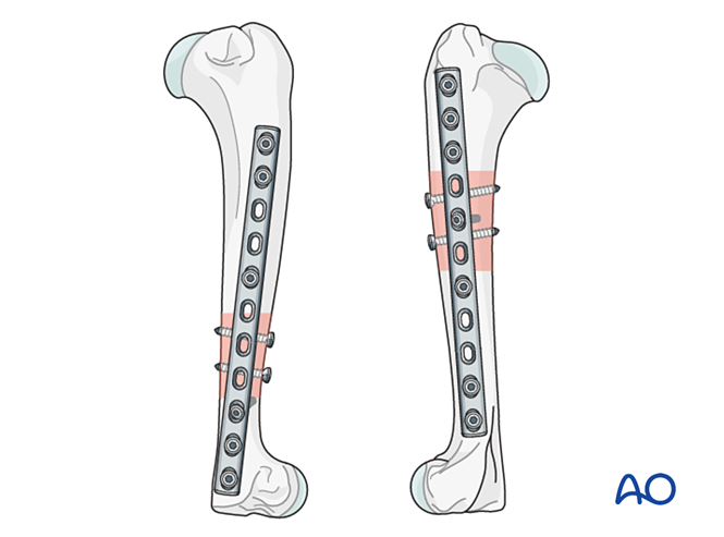 Lag screws and neutralization plate for Dog humeral diaphyseal fracture ...