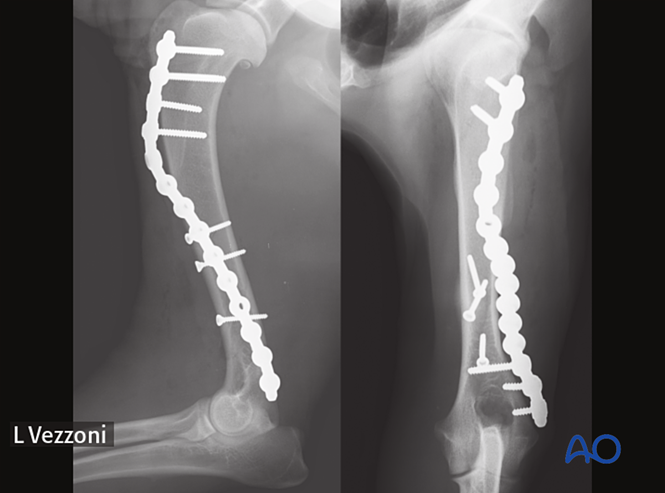 Lag screws and neutralization plate for Dog humeral diaphyseal fracture ...