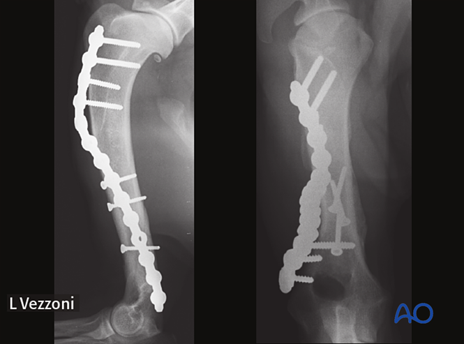 Lag screws and neutralization plate for Dog humeral diaphyseal fracture ...
