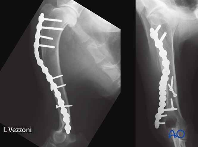 Lag screws and neutralization plate for Dog humeral diaphyseal fracture ...