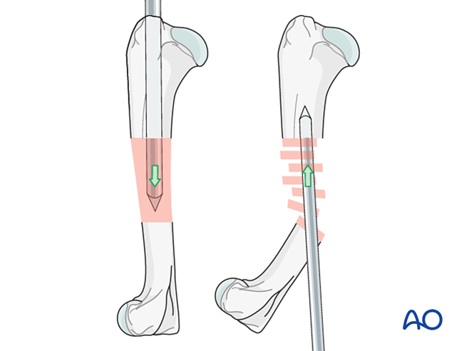 Cerclage wires and intramedullary pin for Simple oblique fracture of ...