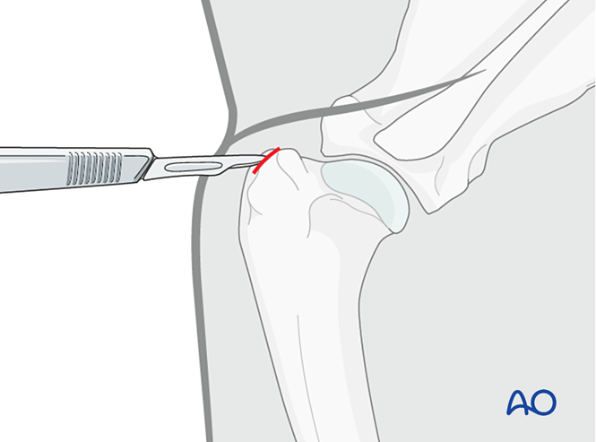 Cerclage wires and intramedullary pin for Simple oblique fracture of ...