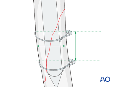 Cerclage wires and intramedullary pin for Simple oblique fracture of ...