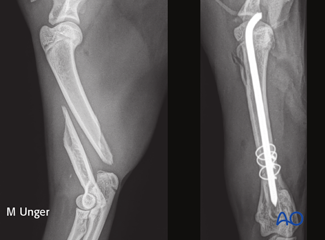 Cerclage wires and intramedullary pin for Simple oblique fracture of ...