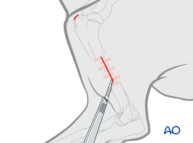 Cerclage wires and intramedullary pin for Simple oblique fracture of ...