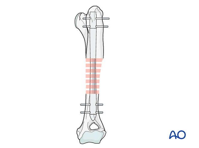 Interlocking nail for Dog humeral diaphyseal fracture with complex ...