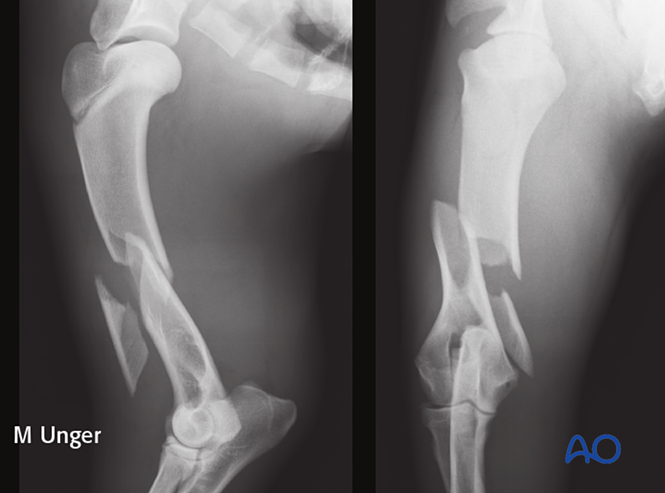 Interlocking nail for Dog humeral diaphyseal fracture with one ...