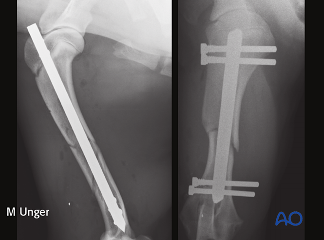 Interlocking nail for Dog humeral diaphyseal fracture with complex ...