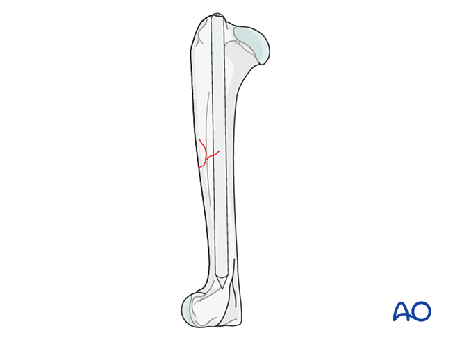 Intramedullary pin for Incomplete fracture of the dog humeral diaphysis