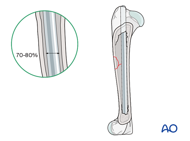 Intramedullary pin for Incomplete fracture of the dog humeral diaphysis