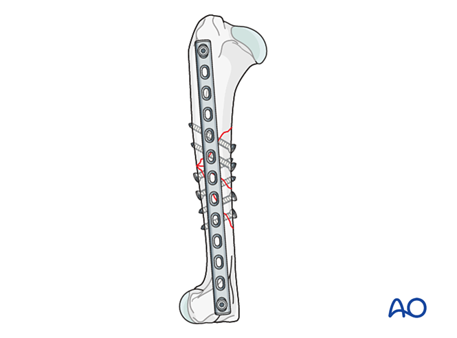 Lag screws and neutralization plate for Dog humeral diaphyseal fracture ...