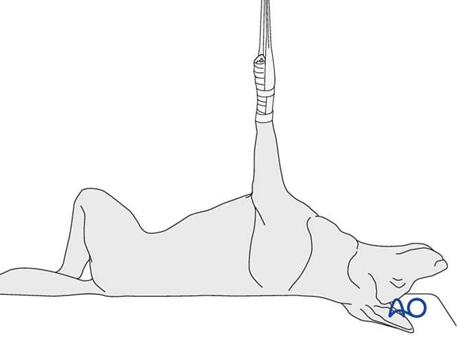 Bridging plate for Incomplete fracture of the dog humeral diaphysis