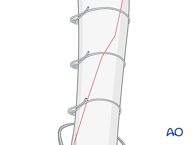 Cerclage wires technique