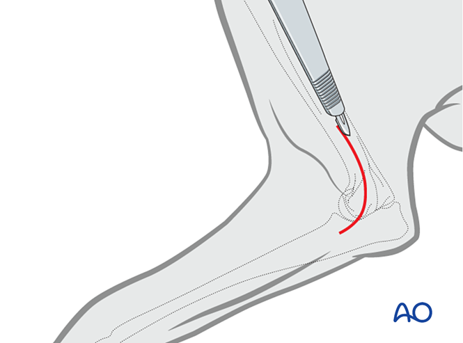 Lateral approach to the dog distal humerus