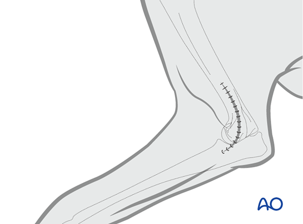 Lateral approach to the dog distal humerus