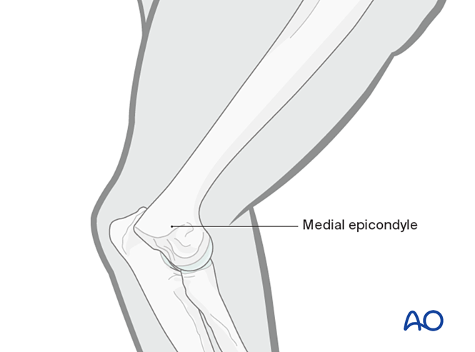 Medial approach to the dog distal humerus