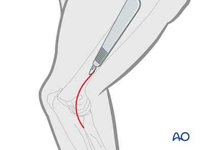 Medial approach to the dog distal humerus