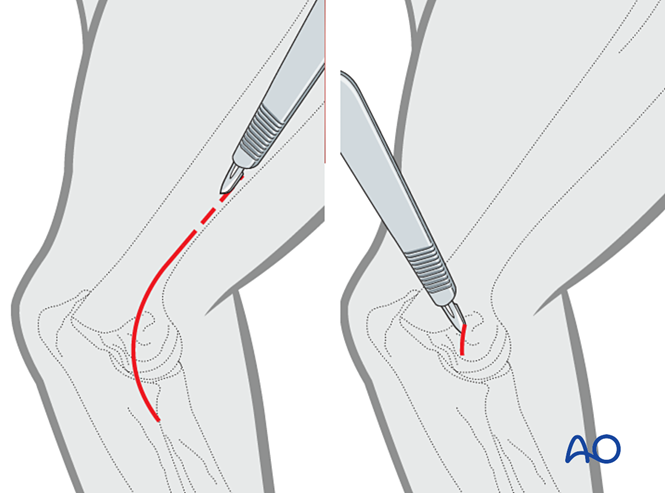 Medial approach to the distal humerus