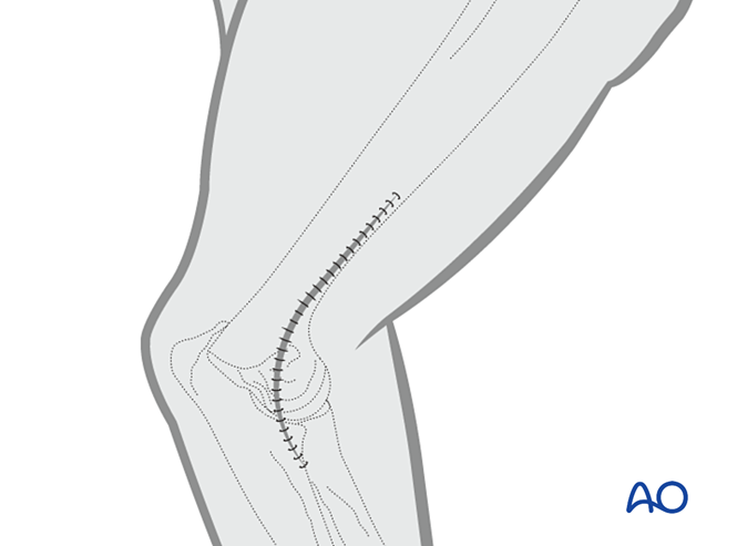 Medial approach to the dog distal humerus