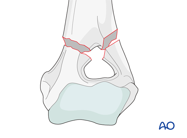 Simple extra-articular fractures of the dog distal humerus