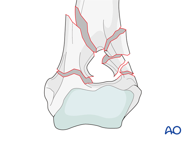 Complex extra-articular fractures of the distal humerus