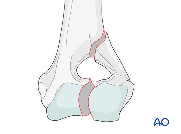 Lateral partial articular fractures of the dog distal humerus