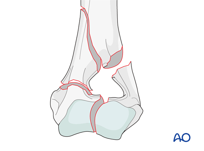 Simple complete articular, metaphyseal wedge fractures of the dog ...