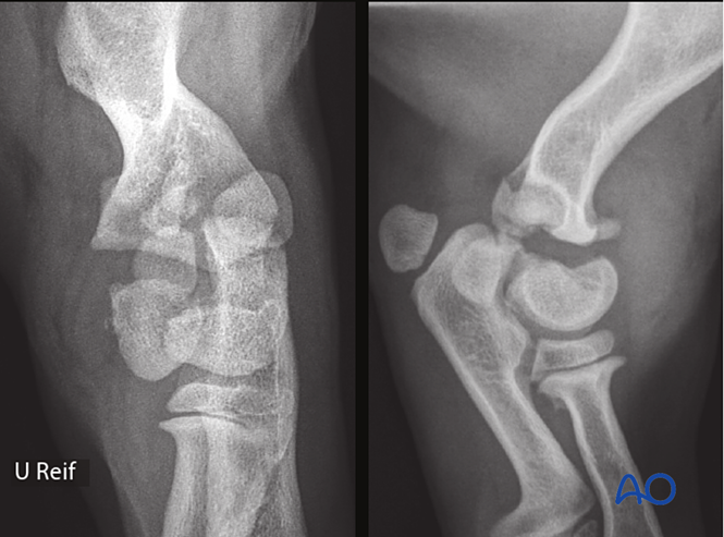 Simple extra-articular fractures of the dog distal humerus
