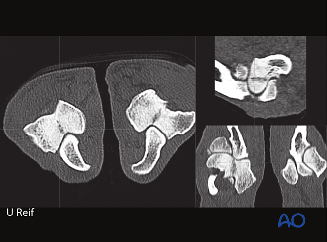 Incomplete ossification of the humeral condyle