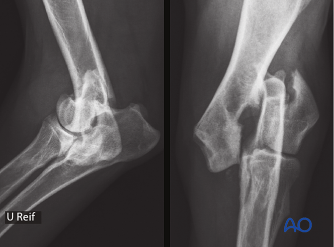 Lateral partial articular fractures of the distal humerus