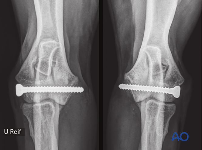 Incomplete ossification of the humeral condyle