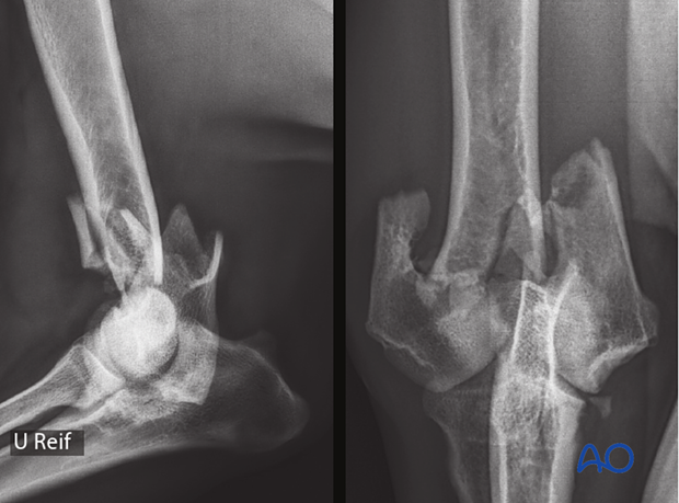Simple complete articular, metaphyseal wedge fractures of the dog ...