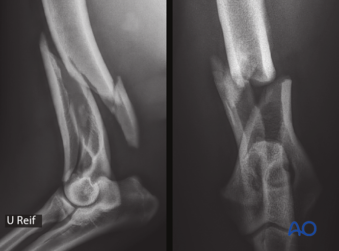Simple complete articular, complex metaphyseal fractures of the dog ...