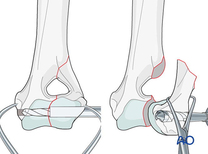 Transcondylar screw and antirotational pin for Lateral partial ...