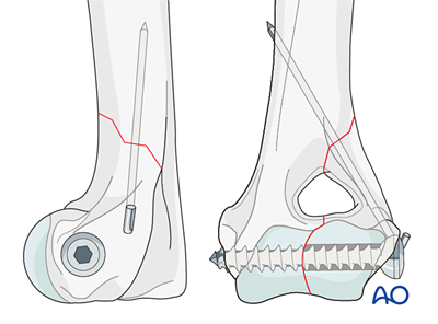 Transcondylar screw and antirotational pin for Lateral partial ...