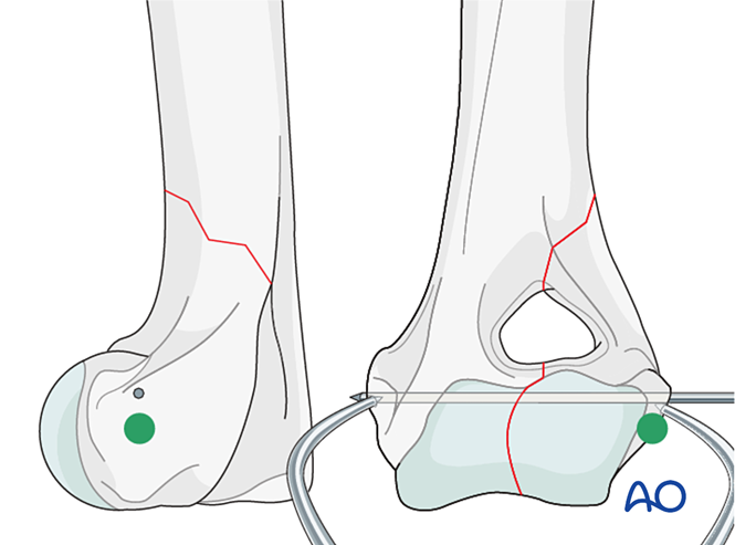 Transcondylar screw and antirotational pin for Lateral partial ...