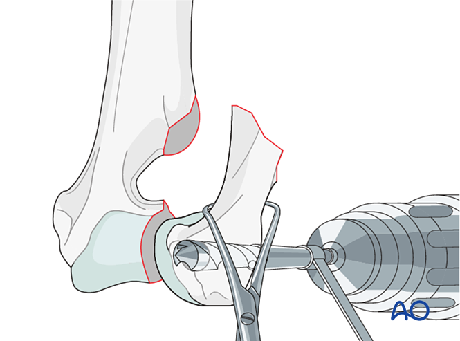 Transcondylar screw and antirotational pin for Lateral partial ...