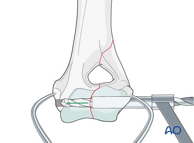 Transcondylar screw and antirotational pin for Lateral partial ...