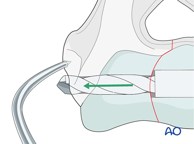 Transcondylar screw and antirotational pin for Lateral partial ...