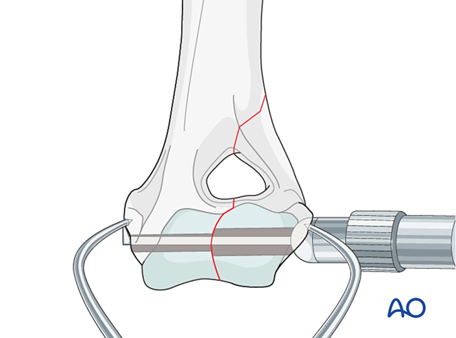 Transcondylar screw and antirotational pin for Lateral partial ...