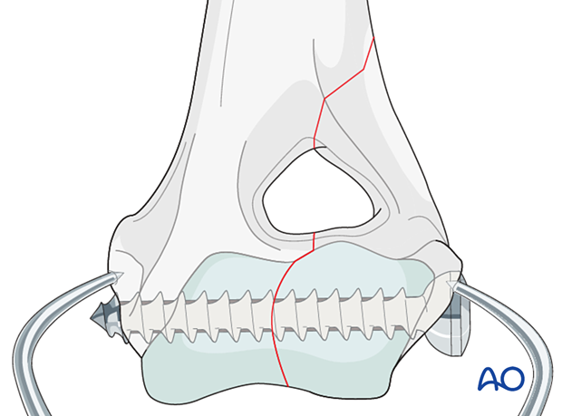 Transcondylar screw and antirotational pin for Lateral partial ...