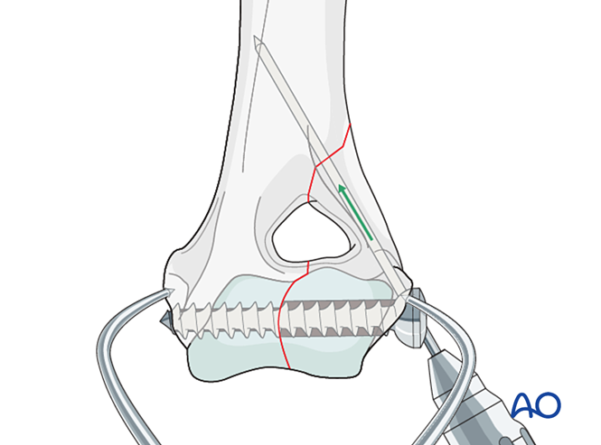 Transcondylar screw and antirotational pin for Lateral partial ...